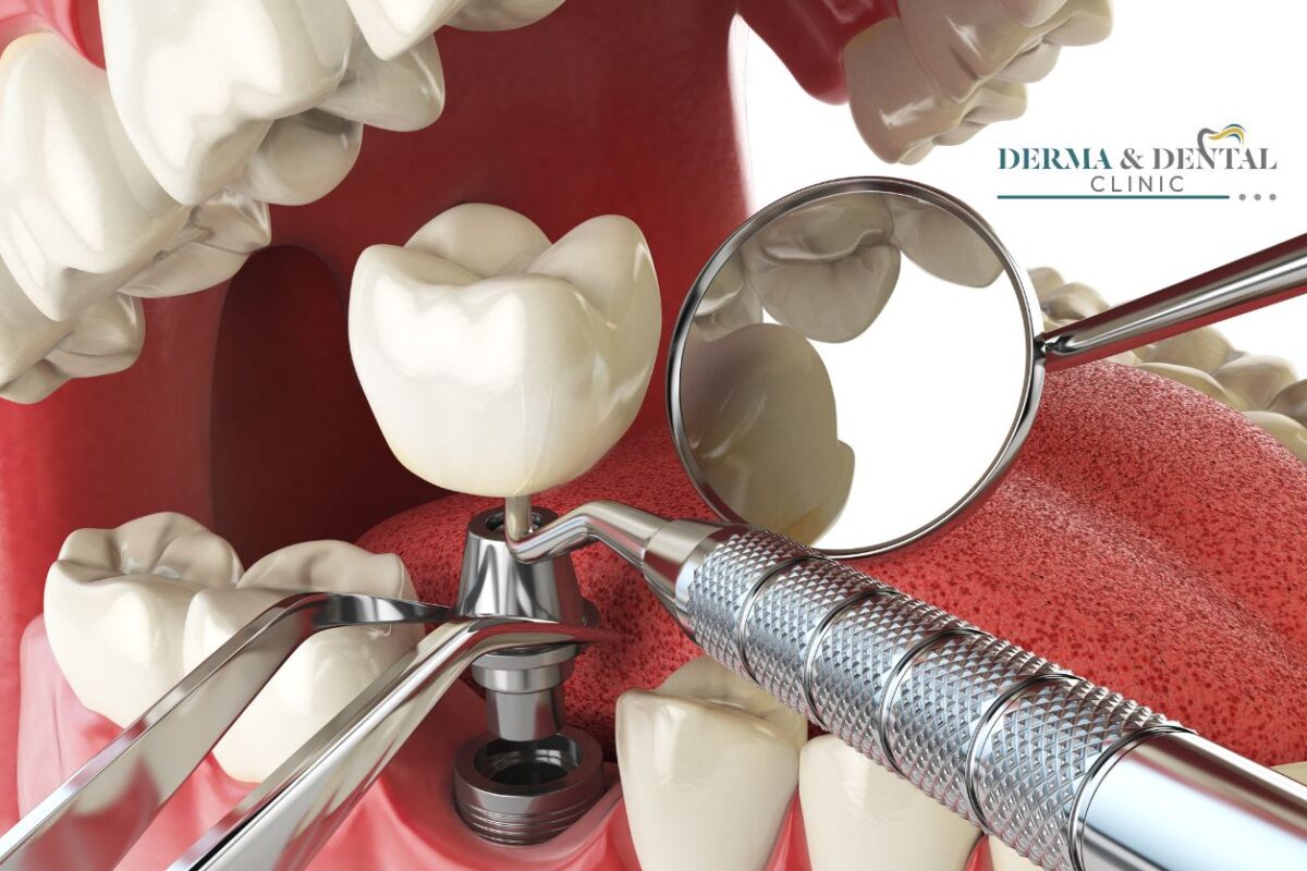 Implant Crown - Skin Clinic by Dr. Eram